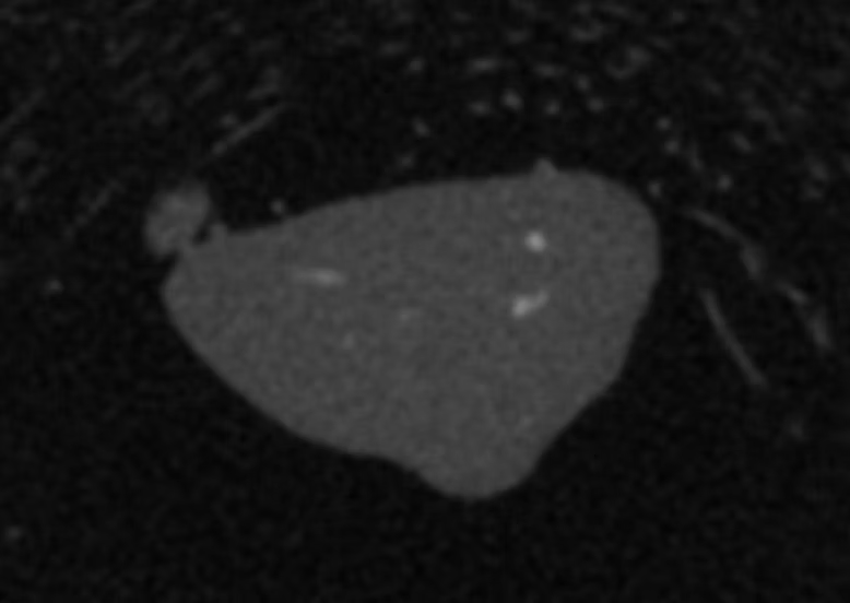 Induce OI9™ Bioimplant | Natural Bone Graft Alternative